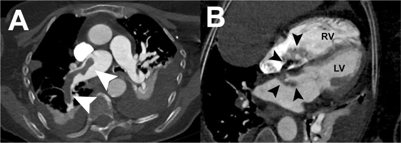 Acute Pulmonary Emboli with Paradoxical Embolus - SmartInject Solutions