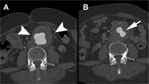 Endovascular Abdominal Aortic Aneurysm Repair (EVAR) - SmartInject Solutions