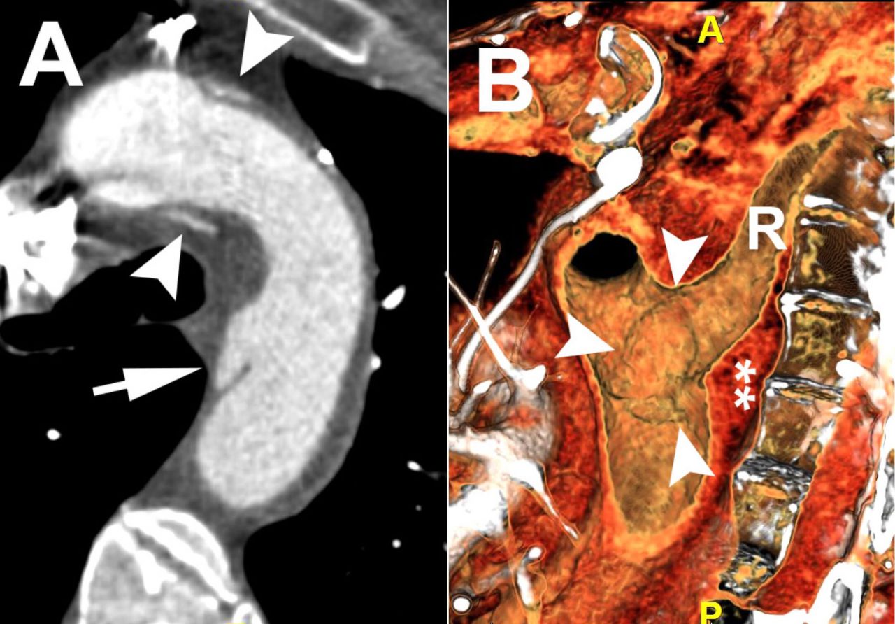Limited Intimal Tear at Aberrant Right Subclavian Artery - SmartInject ...