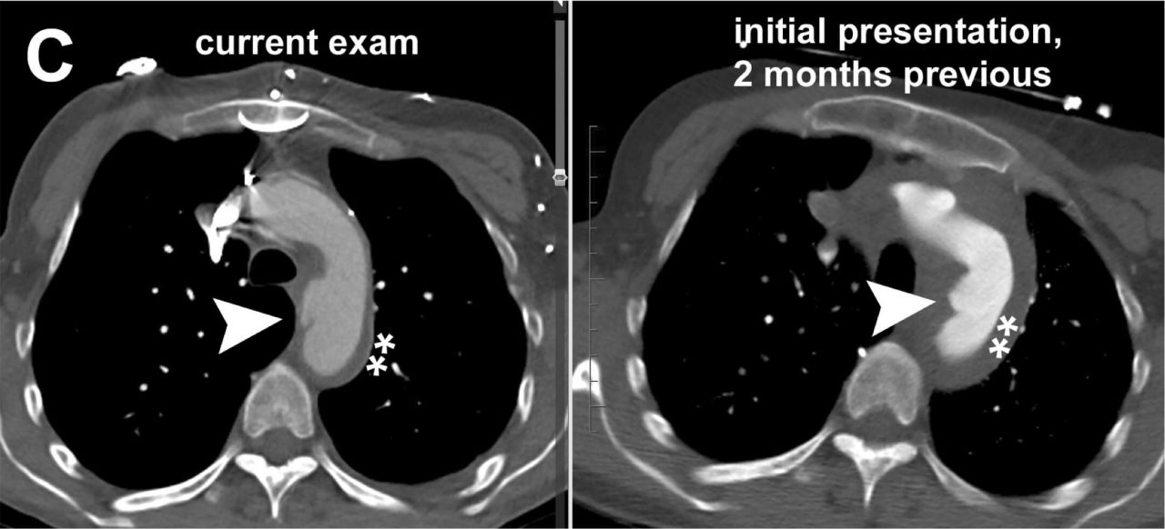 Limited Intimal Tear at Aberrant Right Subclavian Artery - SmartInject ...