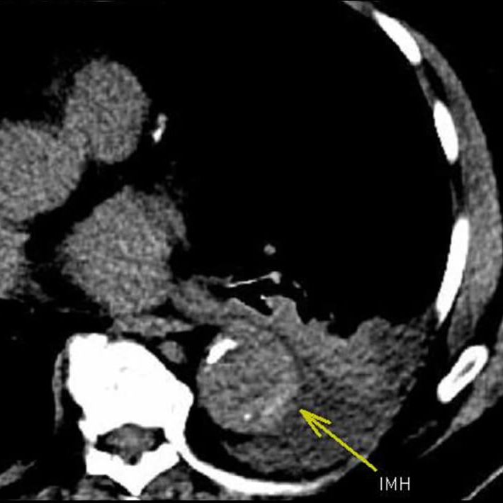 Symptomatic Intramural Hematoma (IMH) from Penetrating Atherosclerotic ...